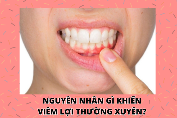 Nguyên nhân gì khiến viêm lợi thường xuyên?
